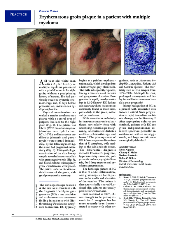 (PDF) Erythematous groin plaque in a patient with multiple myeloma