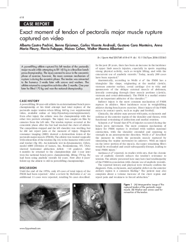 (PDF) Exact moment of tendon of pectoralis major muscle rupture ...