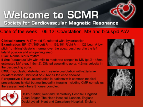 (PPT) Coarctation, Mitral Stenosis and bicuspid Aortic Valve, The Shone ...