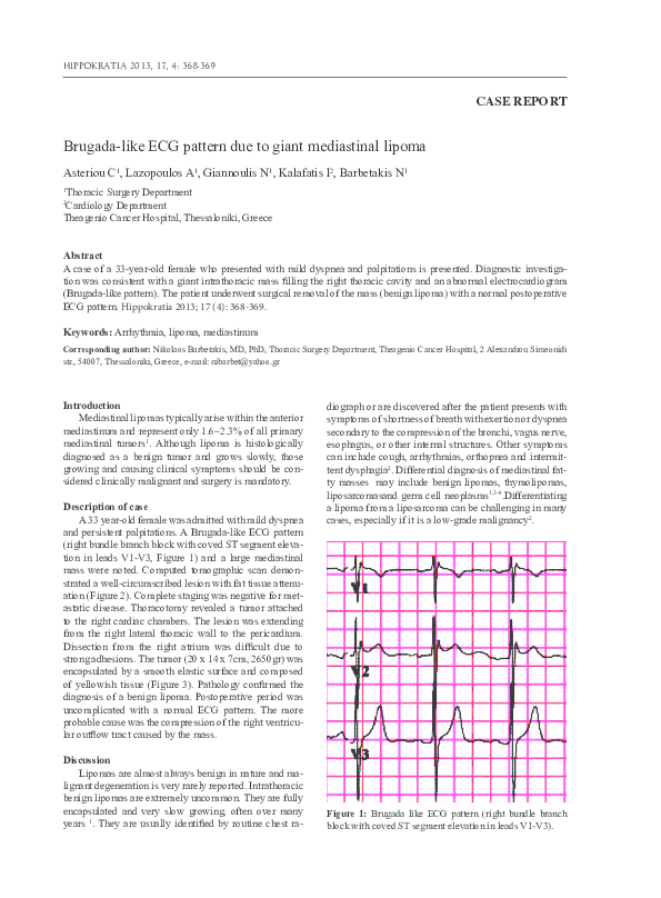 (PDF) Brugada-like ECG pattern due to giant mediastinal lipoma.