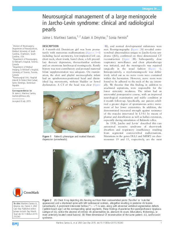 (PDF) Neurosurgical management of a large meningocele in Jarcho-Levin ...