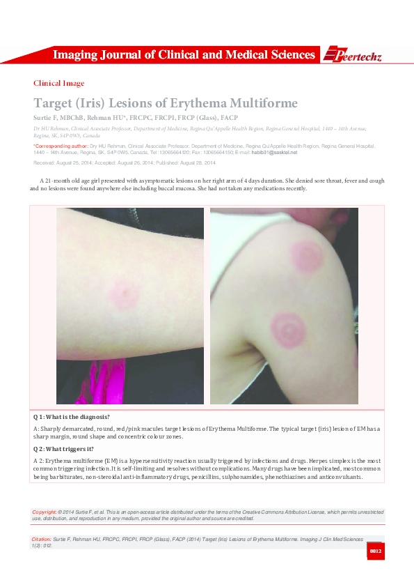 (PDF) Target (Iris) Lesions of Erythema Multiforme