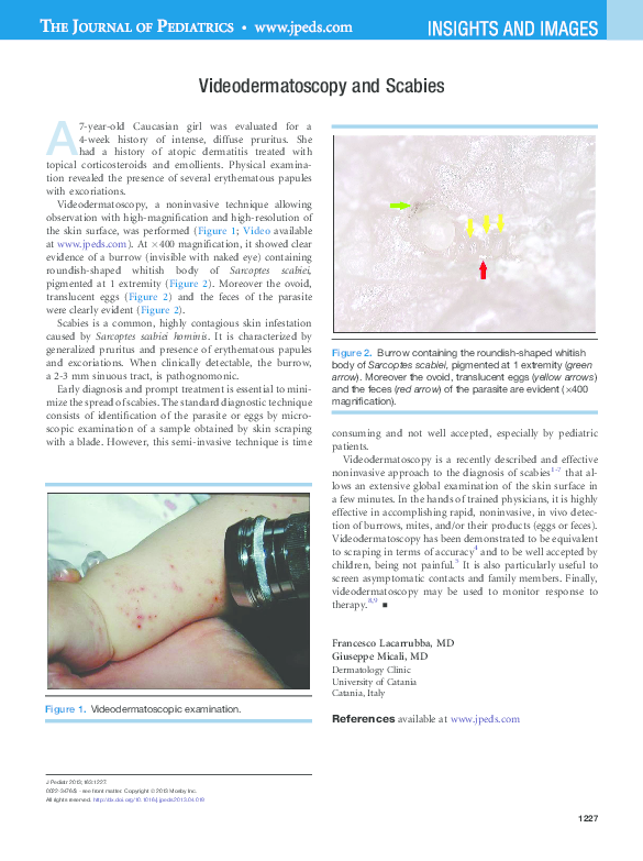 (PDF) Videodermatoscopy and Scabies