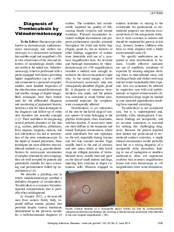 (PDF) Diagnosis of Trombiculosis by Videodermatoscopy