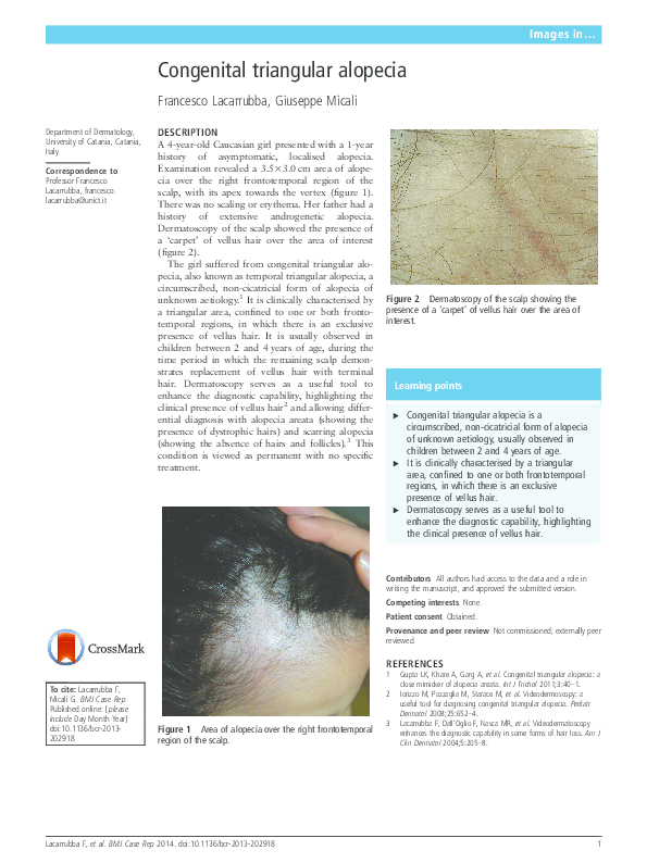 (PDF) Congenital triangular alopecia