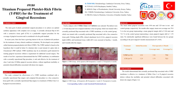 (PPT) Titanium Prepared Platelet-Rich Fibrin for the Treatment of ...