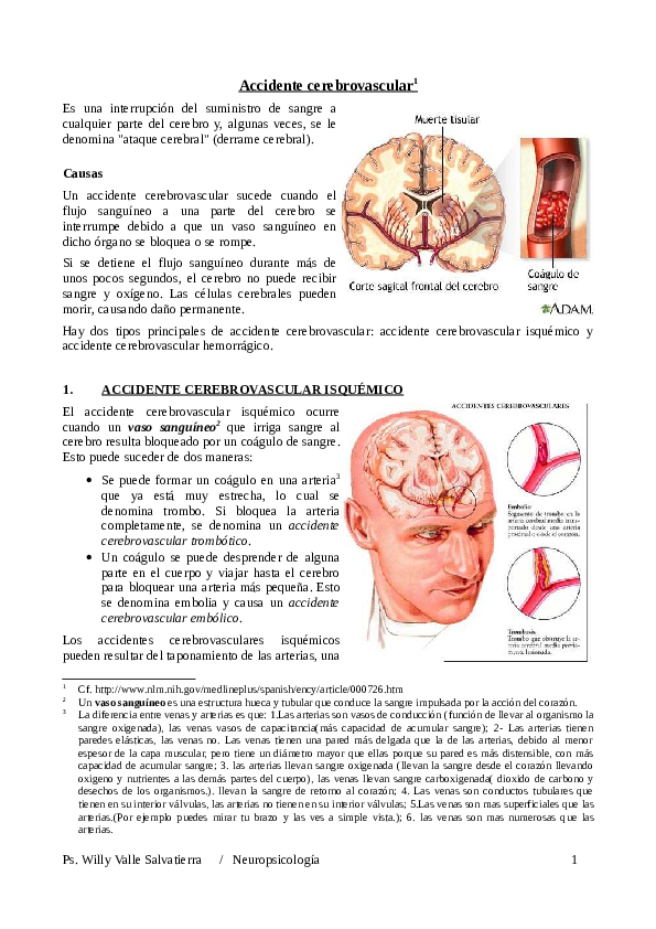 Tipos De Accidente Cerebrovascular Isquemico