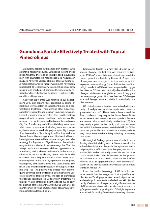 (PDF) Granuloma Faciale Effectively Treated with Topical Pimecrolimus ...
