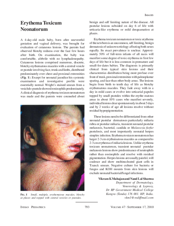 Erythema Toxicum Neonatorum Causes Diagnosis Erythema Neonatal