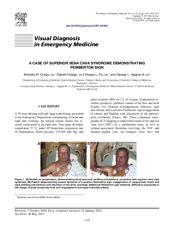 (PDF) Pemberton Sign in Superior Vena Cava Syndrome