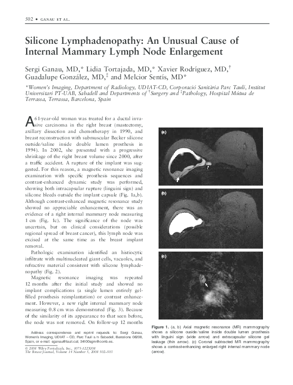 (PDF) Silicone Lymphadenopathy: An Unusual Cause of Internal Mammary Lymph Node Enlargement