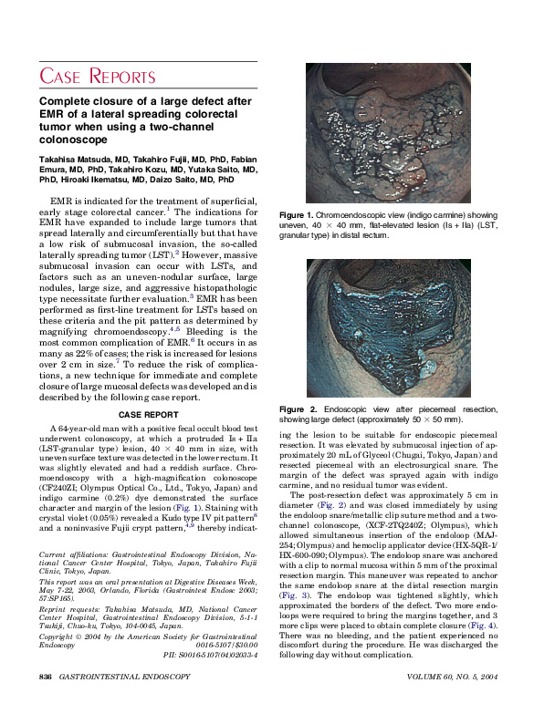 (PDF) Complete closure of a large defect after EMR of a lateral ...