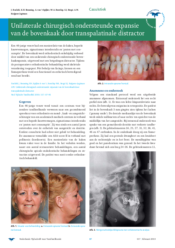 (PDF) [Unilateral surgically assisted rapid maxillary expansion using a ...