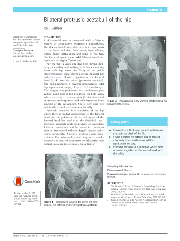 (PDF) Bilateral protrusio acetabuli of the hip