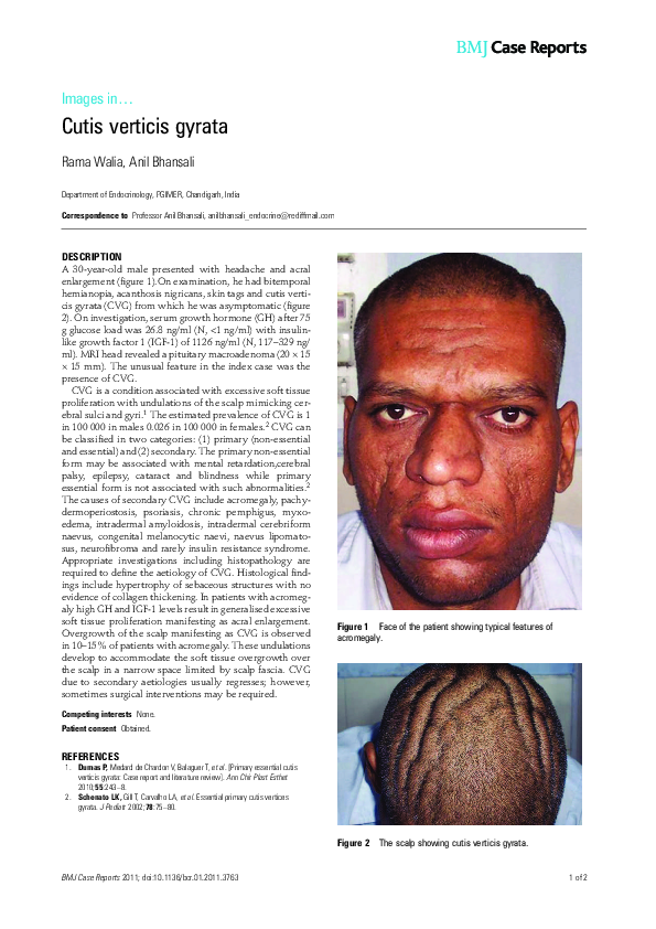 (PDF) Cutis verticis gyrata