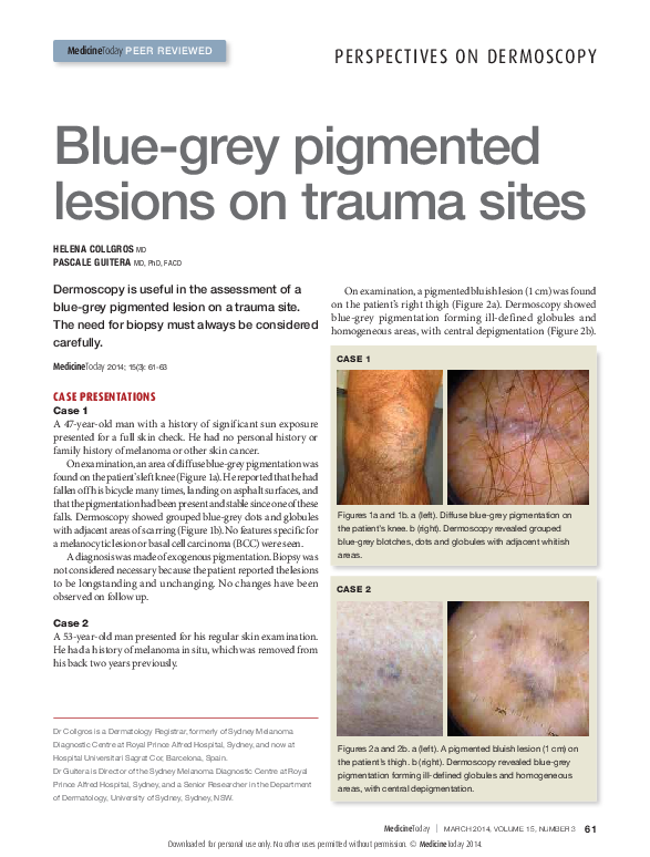 (PDF) Blue-grey pigmented lesions on trauma sites