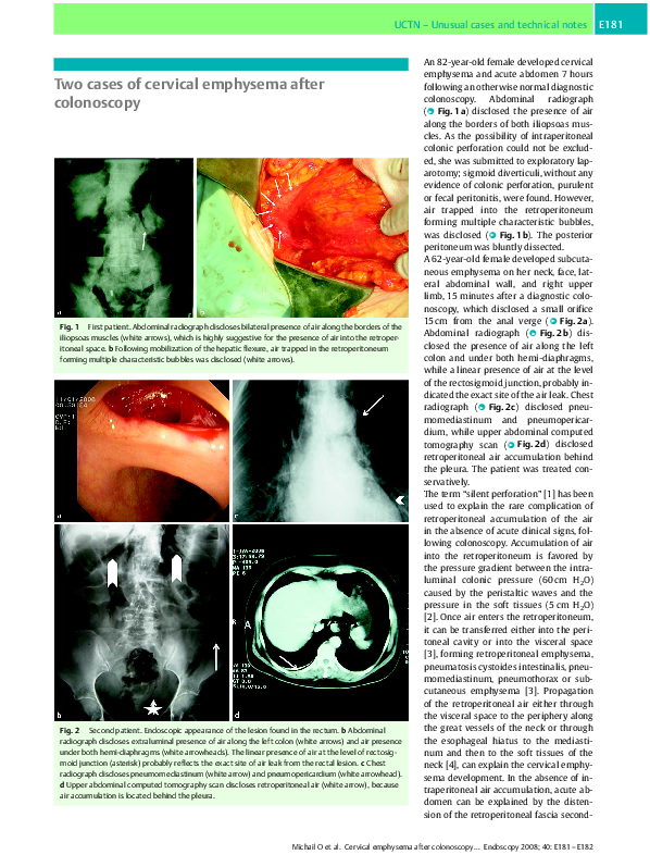 (PDF) Two cases of cervical emphysema after colonoscopy