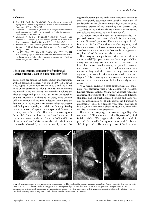 (PDF) Three-dimensional sonography of unilateral Tessier number 7 cleft ...