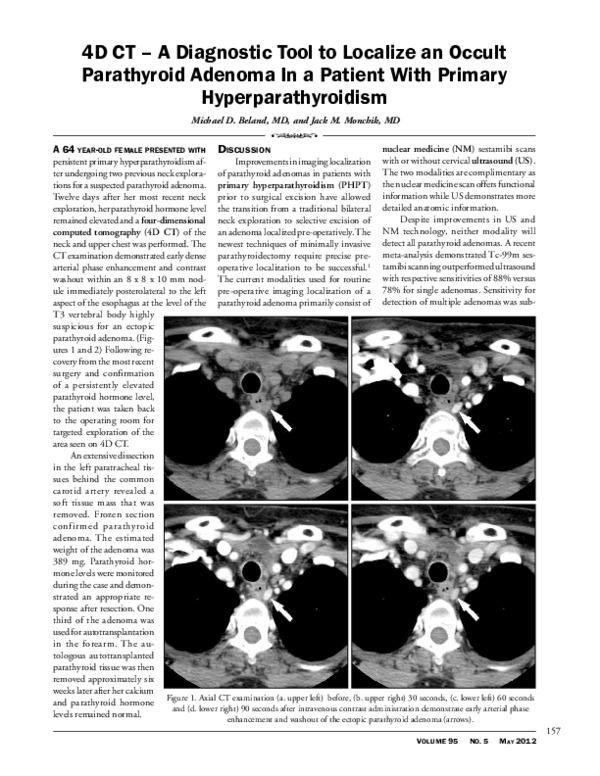 (PDF) 4D CT-A diagnostic tool to localize an occult parathyroid adenoma ...