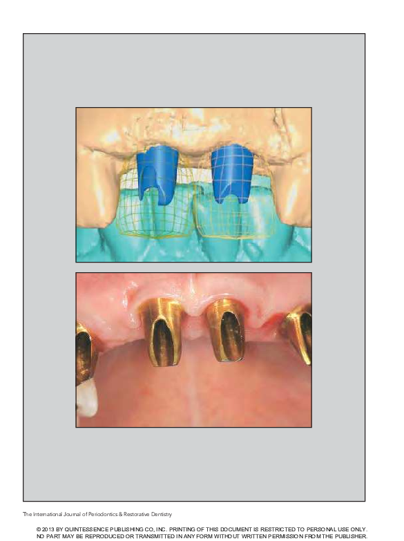 (PDF) Virtual Abutment Design: A Concept for Delivery of CAD/CAM ...