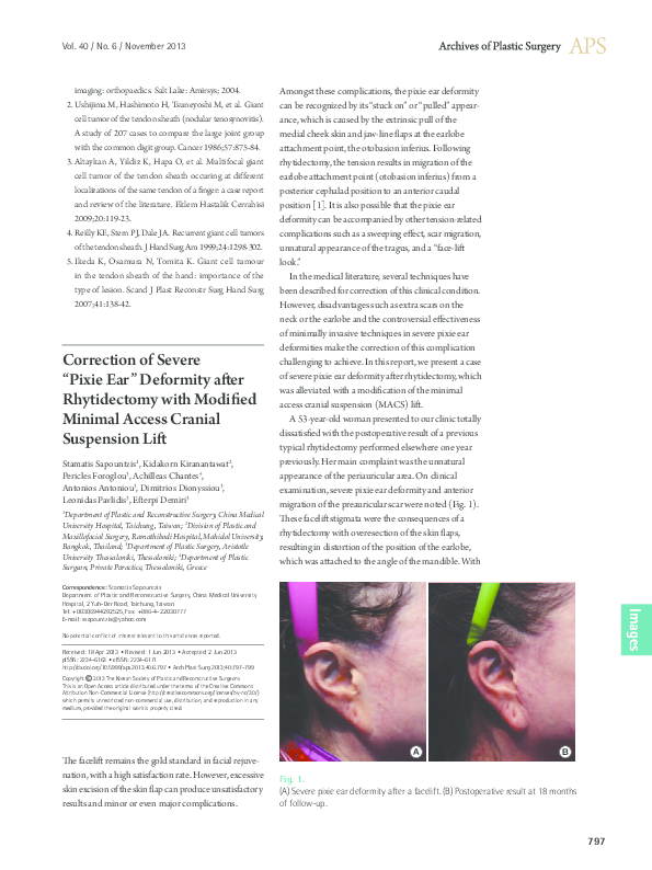 (PDF) Correction of Severe "Pixie Ear" Deformity after Rhytidectomy ...