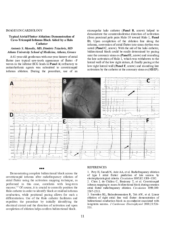 (PDF) Typical Atrial Flutter Ablation: Demonstration of Cavo-Tricuspid ...