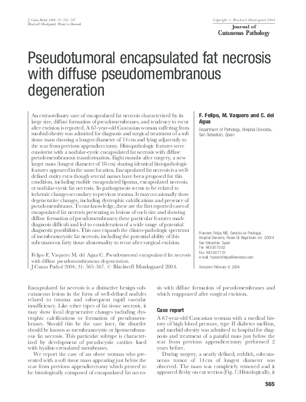(PDF) Pseudotumoral encapsulated fat necrosis with diffuse ...