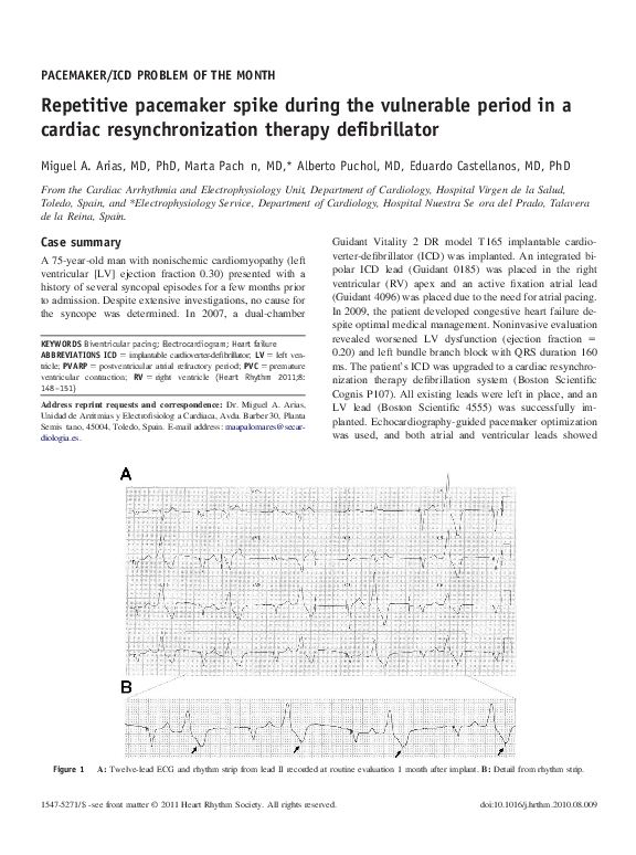 (PDF) Repetitive pacemaker spike during the vulnerable period in a ...