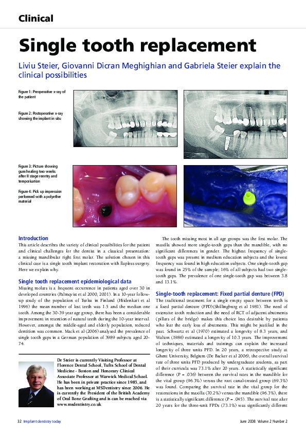 (PDF) Single tooth replacement