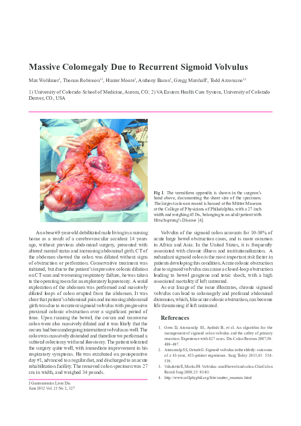 (PDF) Massive colomegaly due to recurrent sigmoid volvulus