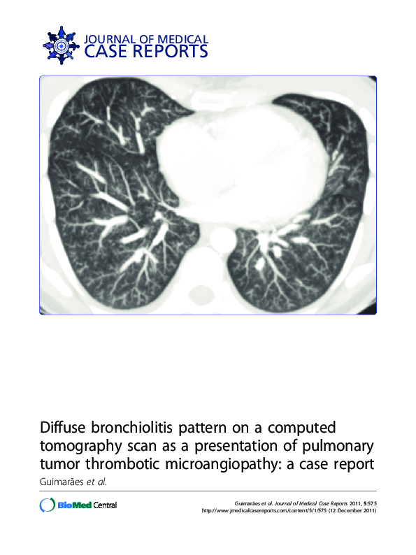 (PDF) Diffuse bronchiolitis pattern on a computed tomography scan as a ...