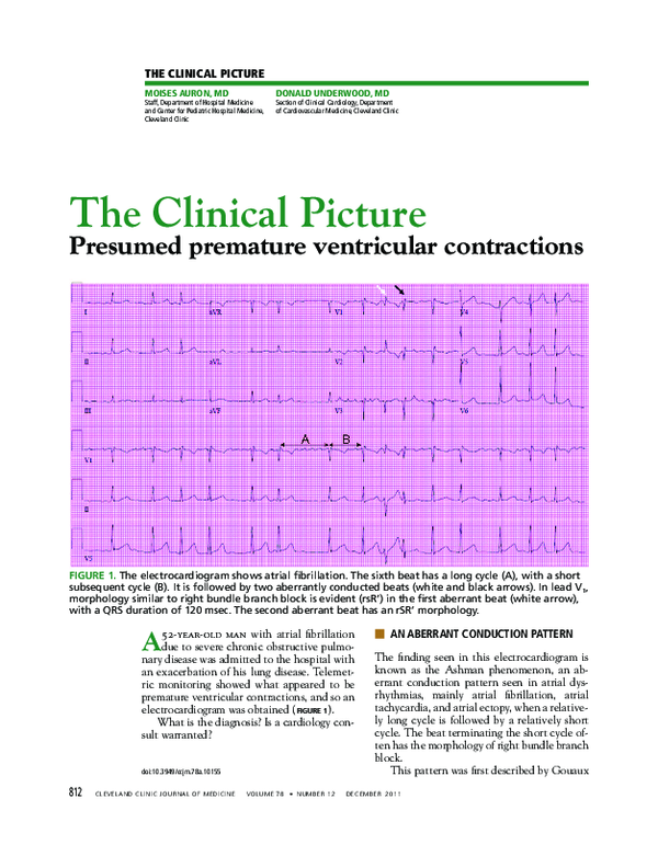 (PDF) Presumed premature ventricular contractions