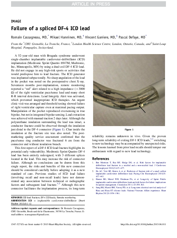 (PDF) Failure of a spliced DF-4 ICD lead | Mikael Hanninen and Romain ...
