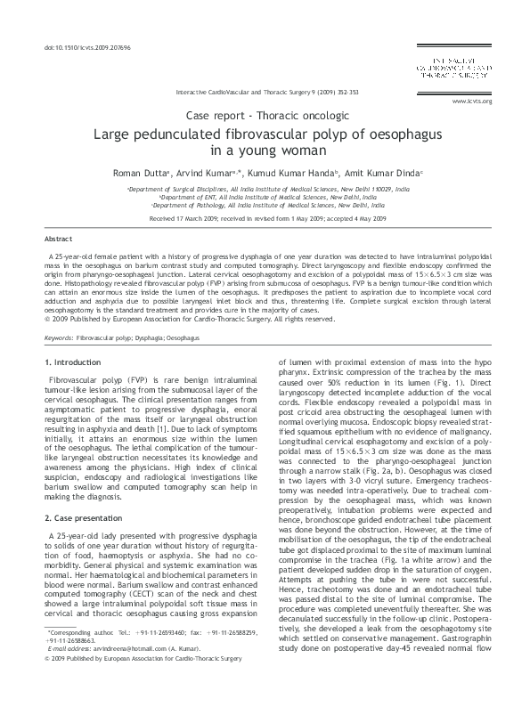 (PDF) Large pedunculated fibrovascular polyp of oesophagus in a young ...