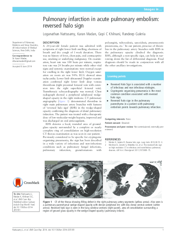 (PDF) Pulmonary infarction in acute pulmonary embolism: reversed halo sign