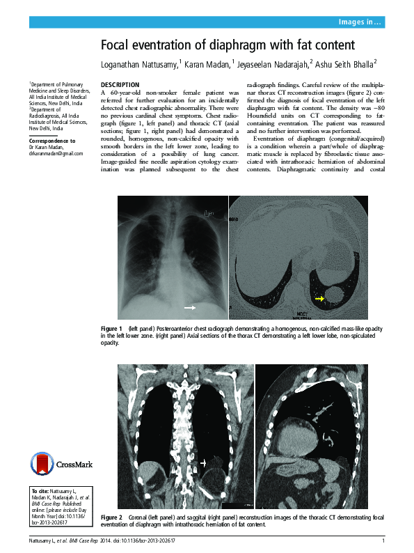 (PDF) Focal eventration of diaphragm with fat content