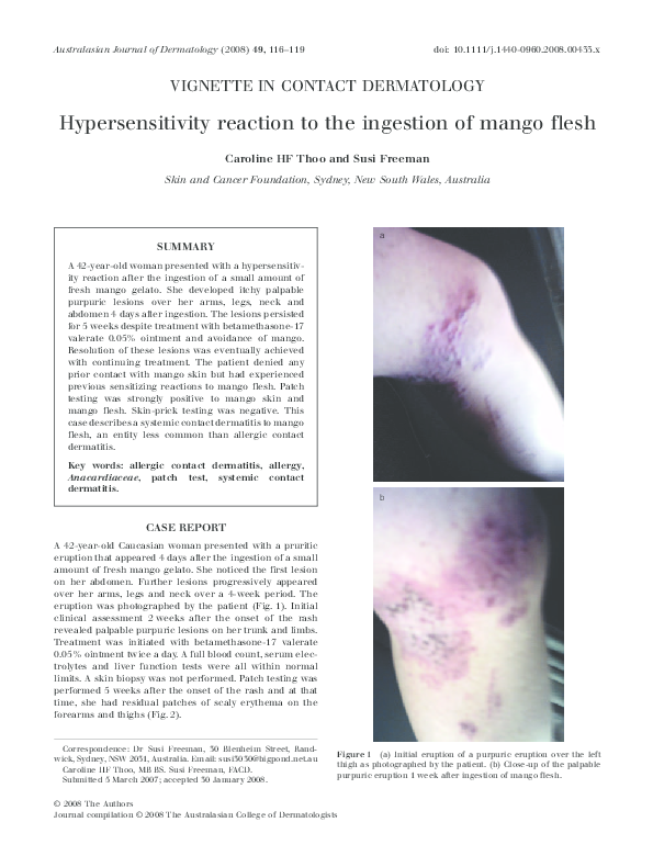 (PDF) Hypersensitivity reaction to the ingestion of mango flesh