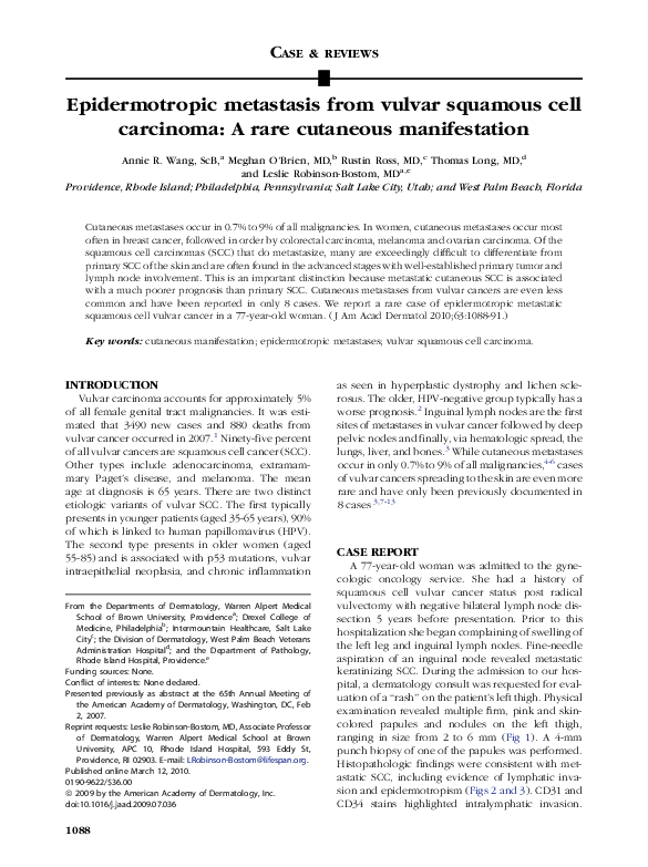 (PDF) Epidermotropic metastasis from vulvar squamous cell carcinoma: A rare cutaneous manifestation