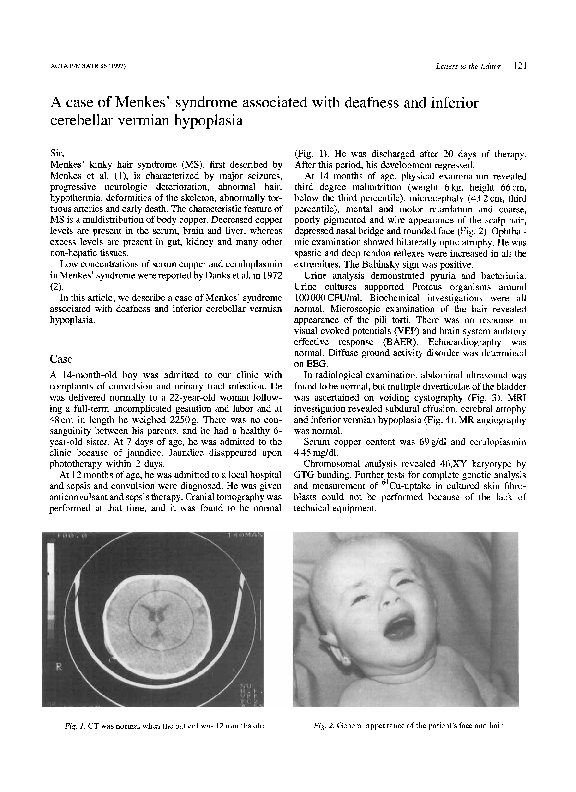 (PDF) A case of Menkes' syndrome associated with deafness and inferior ...