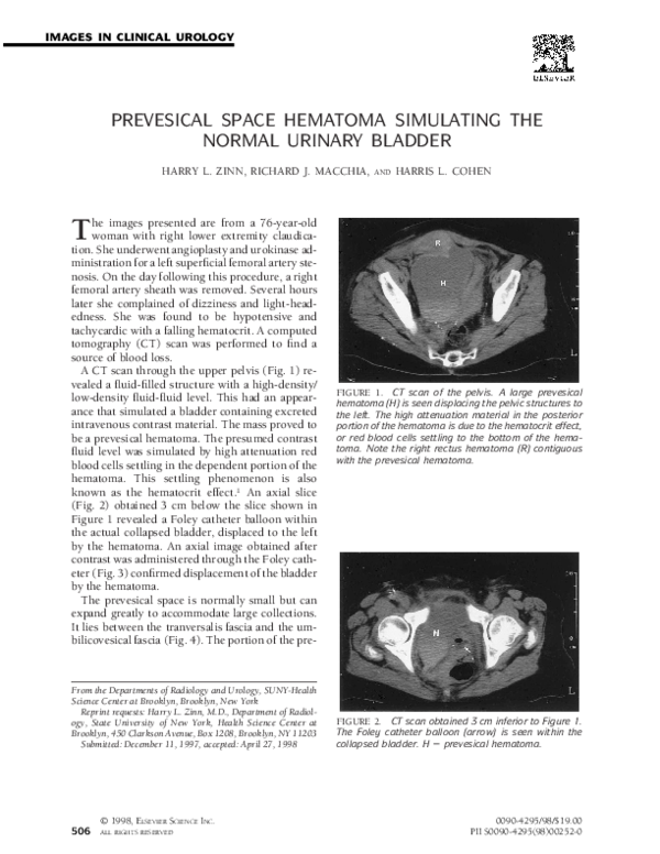 (PDF) Prevesical space hematoma simulating the normal urinary bladder ...