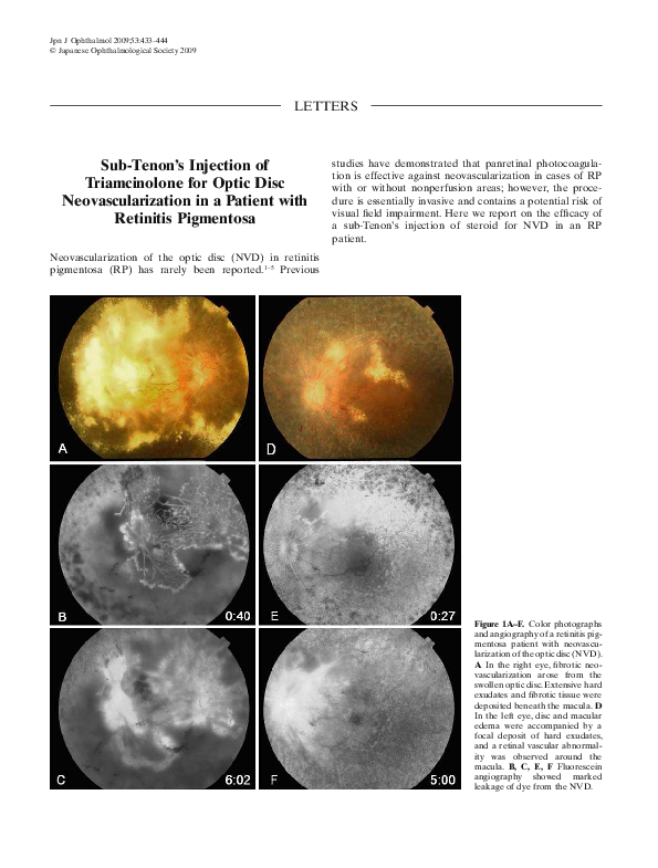(PDF) Sub-Tenon’s injection of triamcinolone for optic disc ...