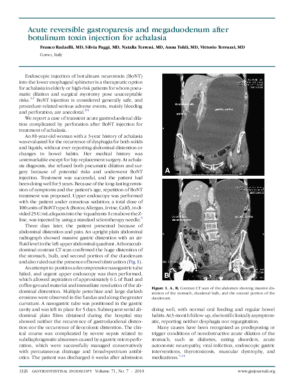 (PDF) Acute reversible gastroparesis and megaduodenum after botulinum ...