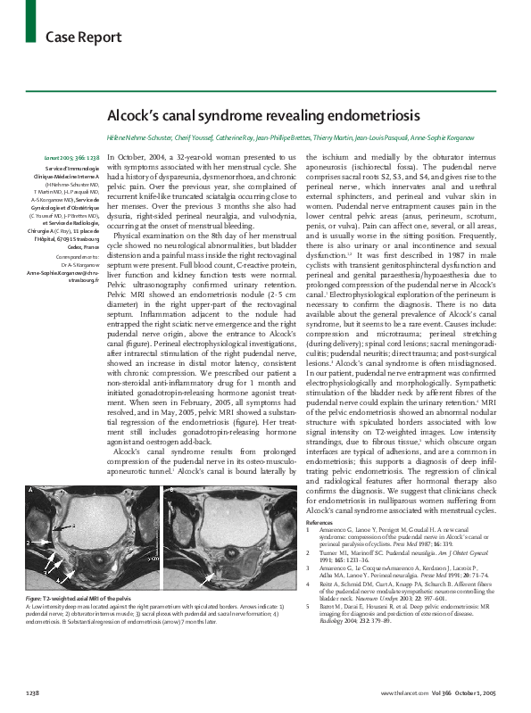 (PDF) Alcock's canal syndrome revealing endometriosis