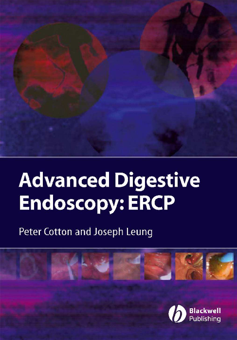 (PDF) ERCP in acute pancreatitis