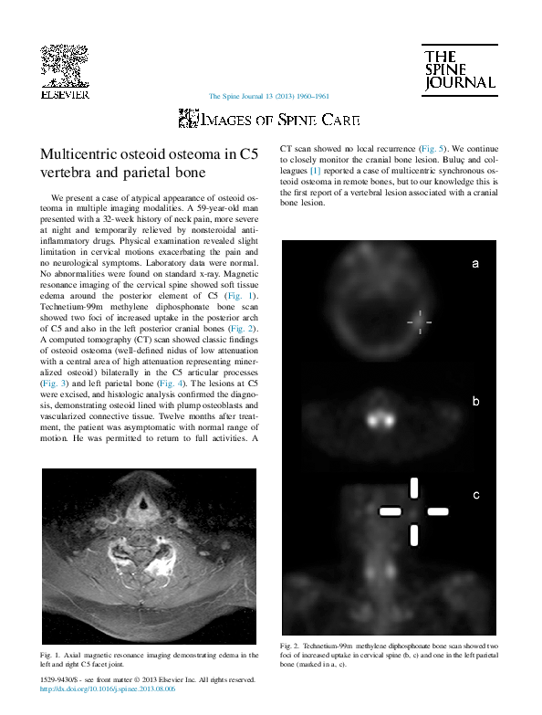 (PDF) Multicentric osteoid osteoma in C5 vertebra and parietal bone