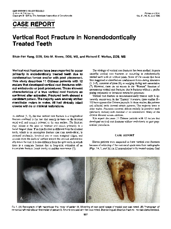 (PDF) Resective Procedure in the Management of Maxillary Molar with ...