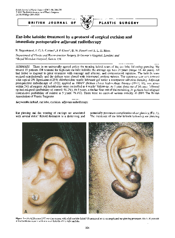 (PDF) Ear-lobe keloids: treatment by a protocol of surgical excision ...