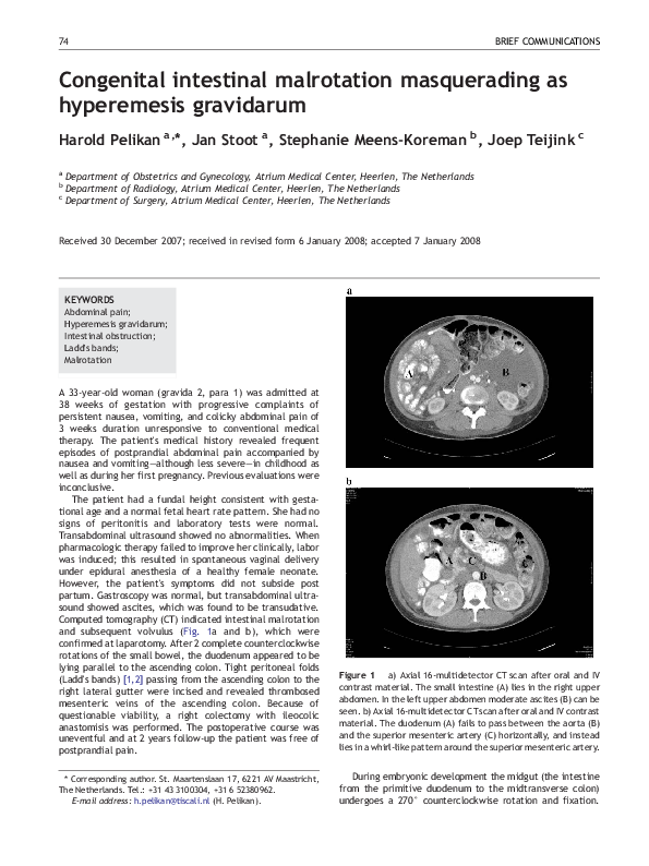 (PDF) Congenital intestinal malrotation masquerading as hyperemesis ...