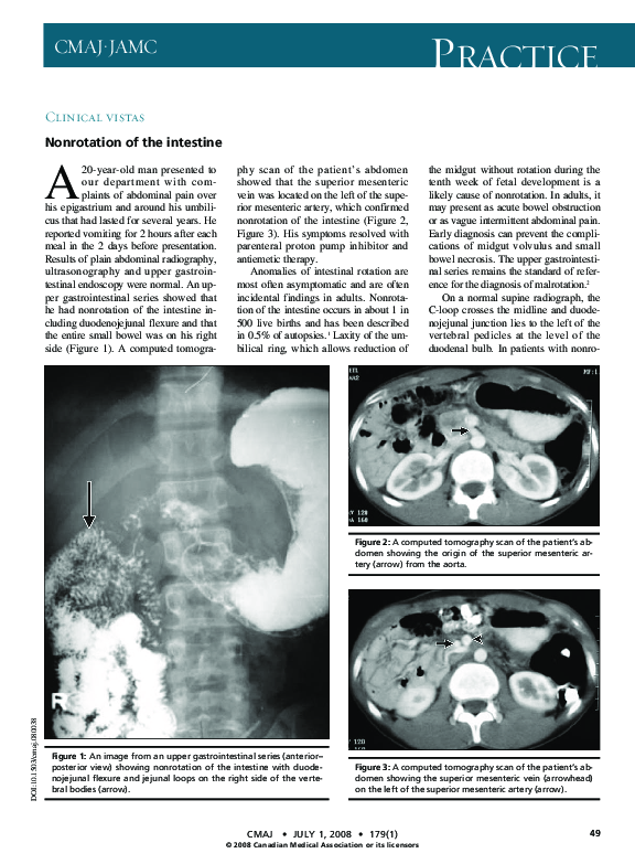 (PDF) Nonrotation of the intestine