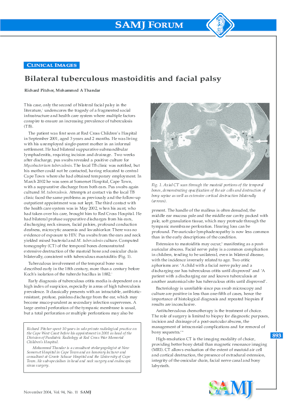 (PDF) Bilateral tuberculous mastoiditis and facial palsy